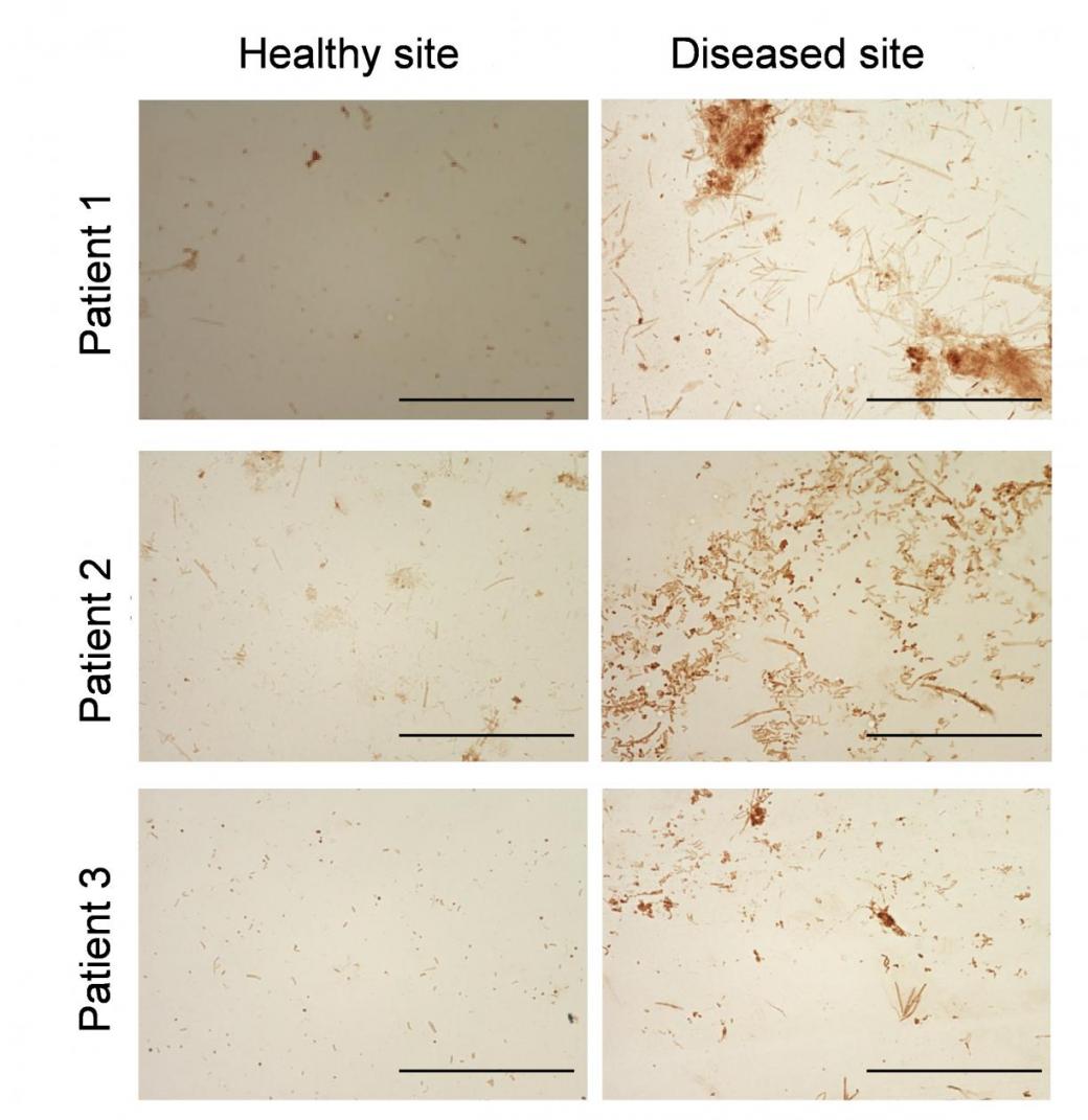 A Clumping Protein Lets Common Oral Bacteria Shift From Harmless to ...