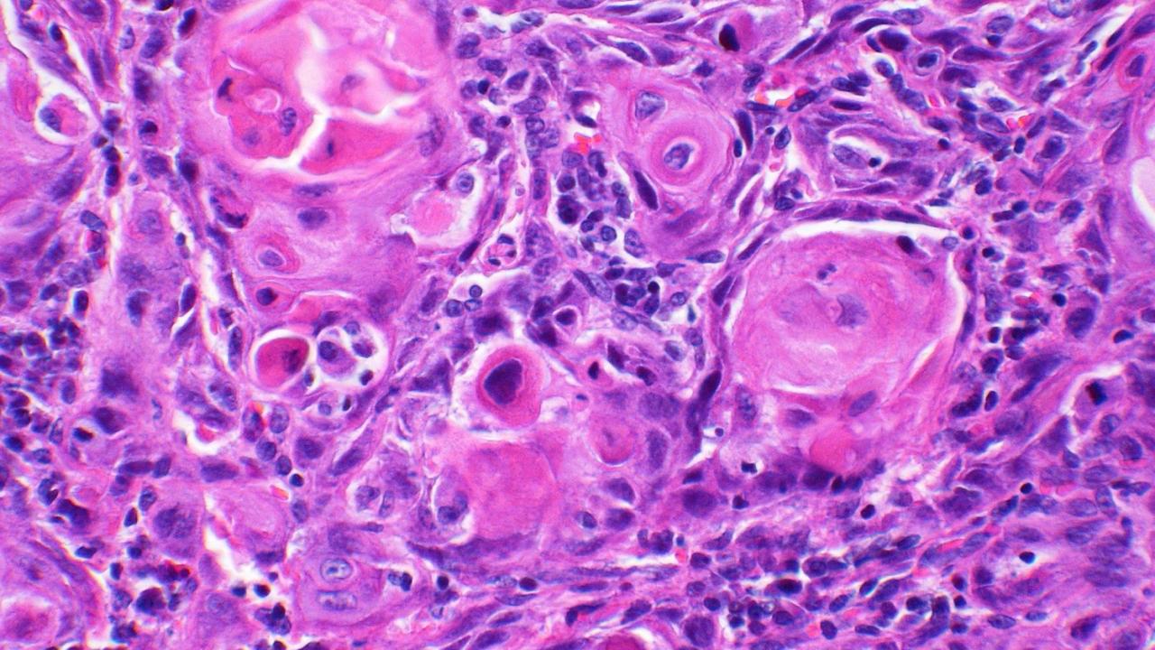 Angela Yoon Seeks Precision Care for Oral Cancer | College of Dental ...