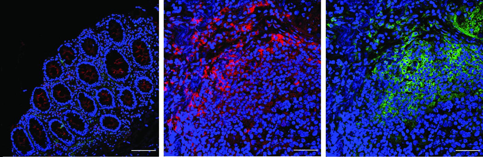 How A Common Oral Bacteria Makes Colon Cancer More Deadly | College of ...